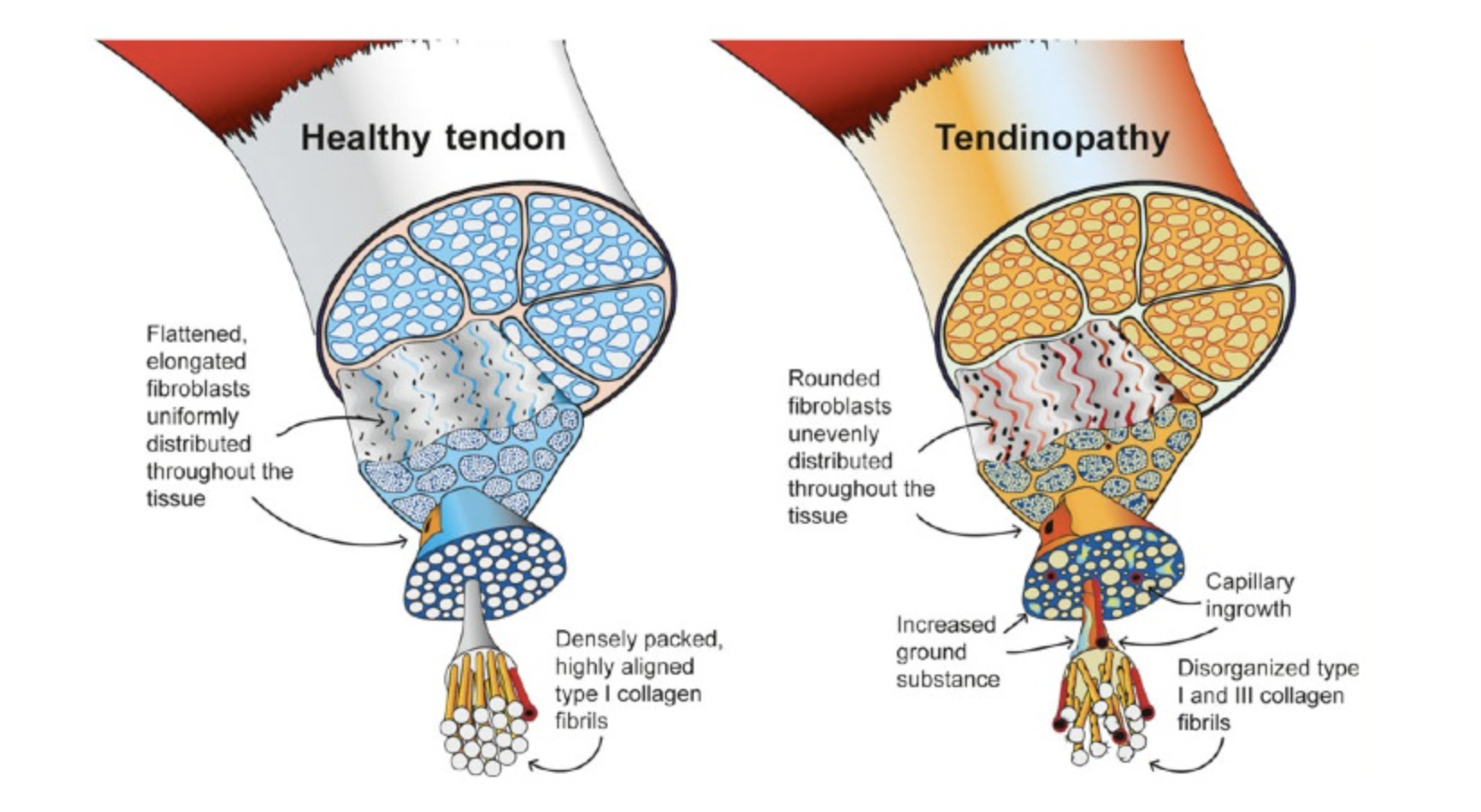 Tendinopathy | Melbourne Massage and Treatment