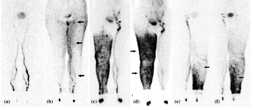 Diagnosis of Lymphoedema - Melbourne Massage and Treatment Fitzroy ...